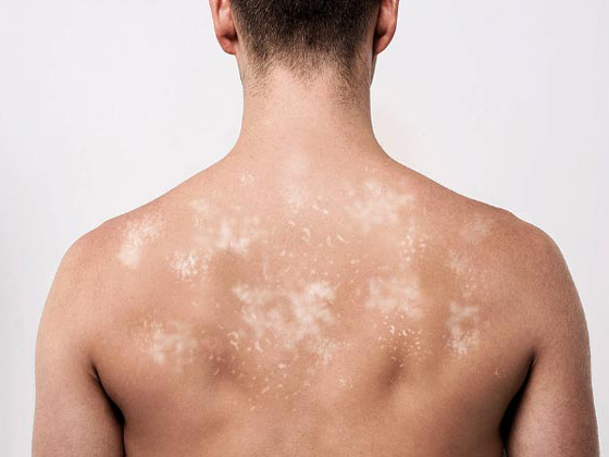 Após 13 anos em queda, hanseníase volta a crescer no Brasil